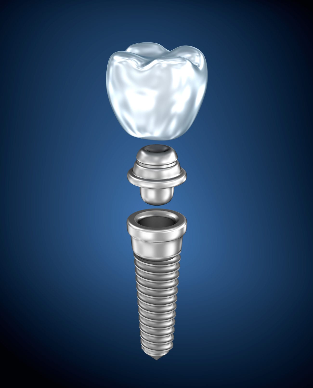 Dental Implants Fox Lake IL | Teeth Implants | Tooth Implant